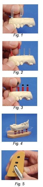 5 Steps to Fabricating Crown & Bridge Models