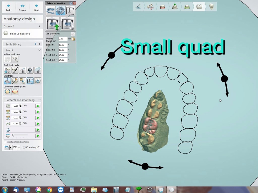 The Proper Setup of the 3Shape Virtual Articulator with Quadrant Models ...