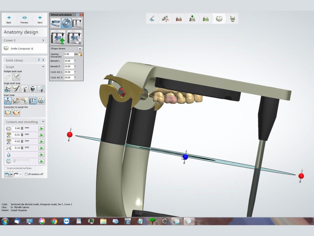 The Proper Setup of the 3Shape Virtual Articulator with Quadrant Models ...