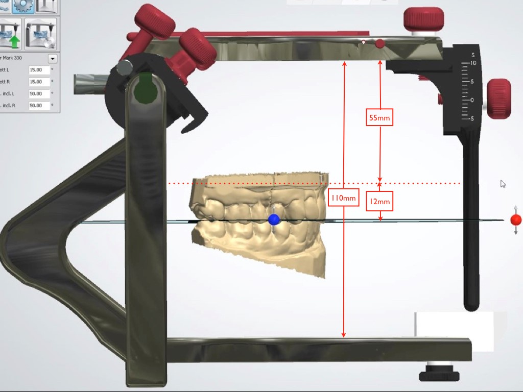 Proper Setup of the 3Shape Virtual Articulator with Full Arch Mounted ...
