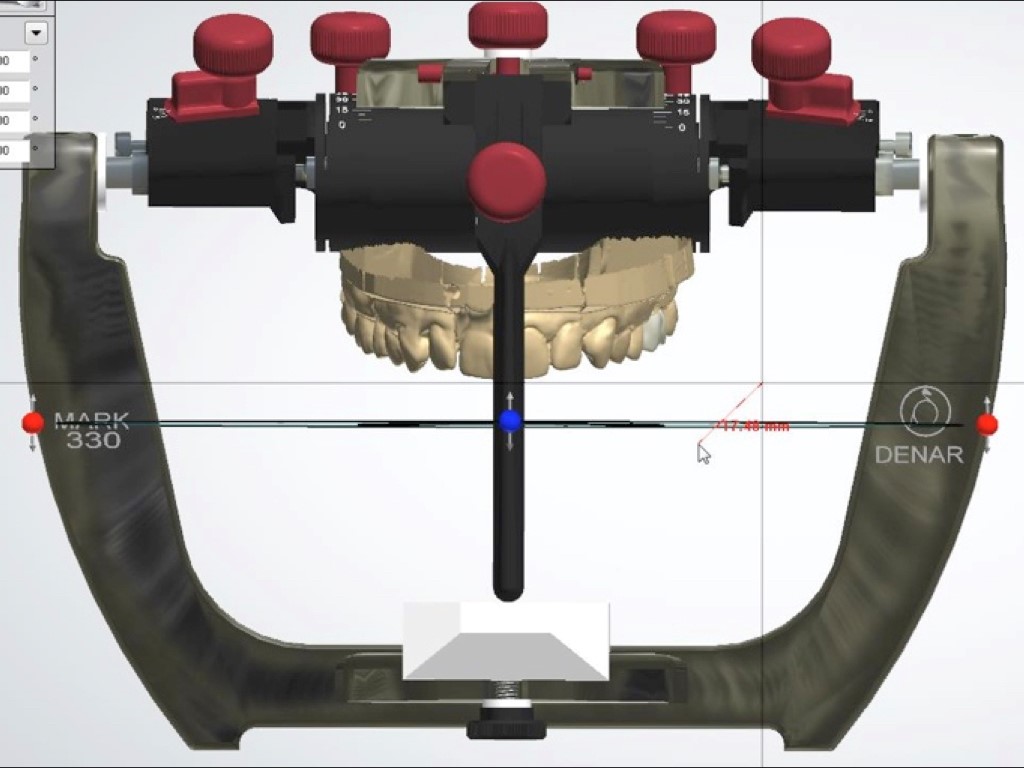 Proper Setup of the 3Shape Virtual Articulator with Full Arch Mounted ...