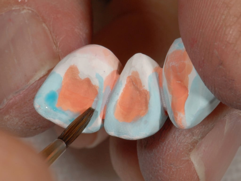 White, Multi-layer, or Shaded Zirconia - Which is right for you?